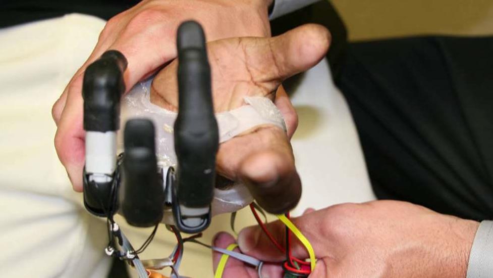 First prosthetic hand with individual finger control | Fox News Video