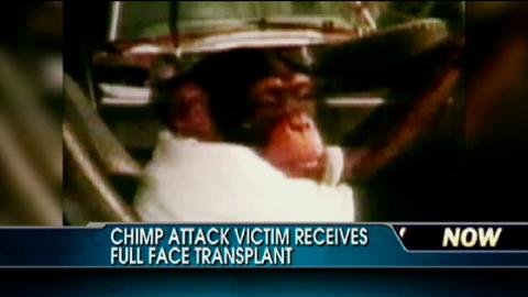 Chimp Attack Victim Receives Face Transplant | Fox News Video